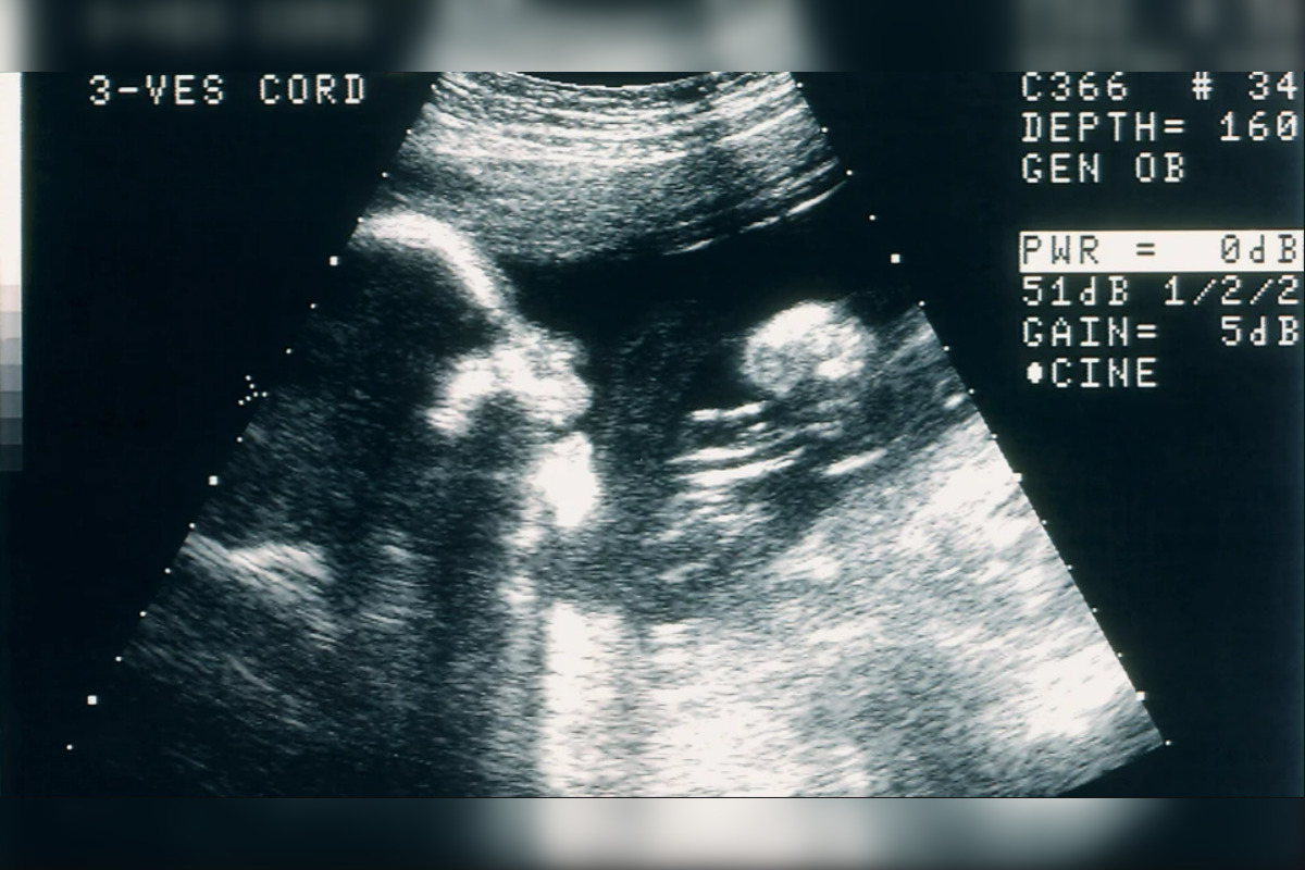 IVF Pioneer Dr. Merle Berger Sued for Allegedly Fathering Patient's