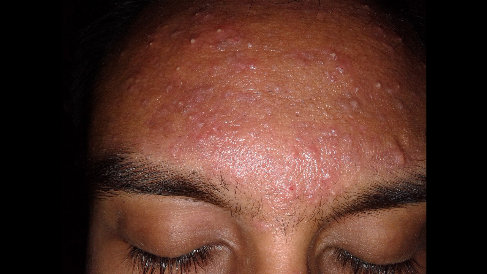 Zit's Incredible! UC San Diego Scientists Engineer Groundbreaking Acne