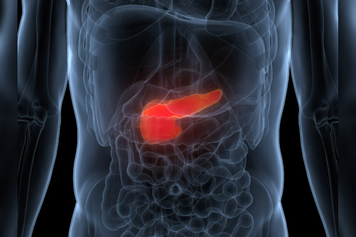 Predicting Pancreatic Peril: AI's Early Warning System Could Be a