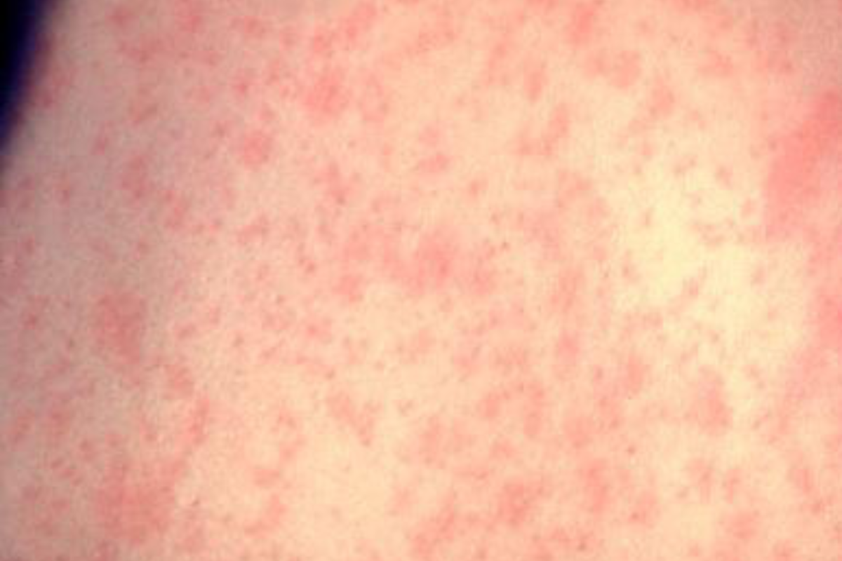 Bay Area Health Officials Issue Measles Alert, Urge Vaccinations Amid Bay Area Health Officials Issue Measles Alert, Urge Vaccinations Amid
