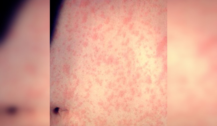 Philadelphia Health Officials Issue Measles Exposure Alert at Philadelphia Health Officials Issue Measles Exposure Alert at