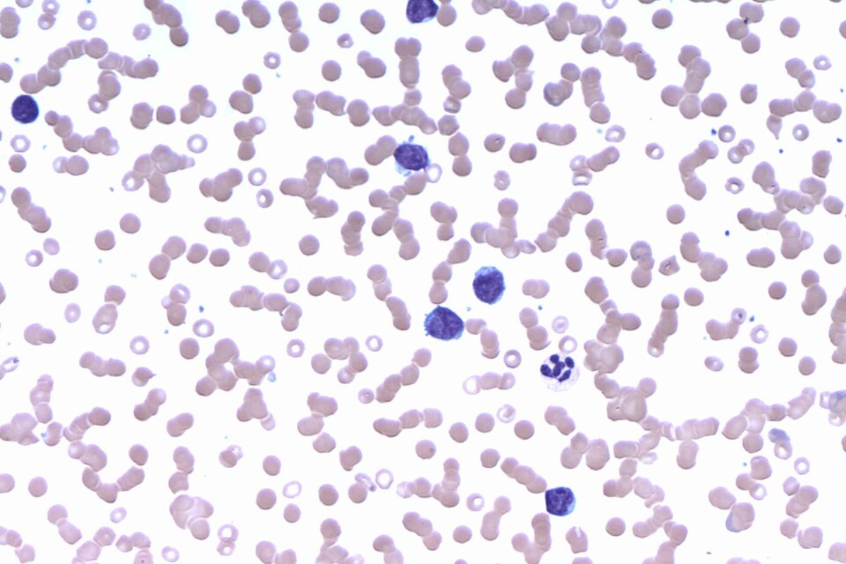 University of Cincinnati Study Unveils Breakthrough in Lymphoma Growth