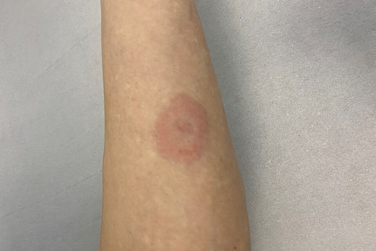 Bay Area Lyme Foundation Launches First Lyme Disease Impact Investment