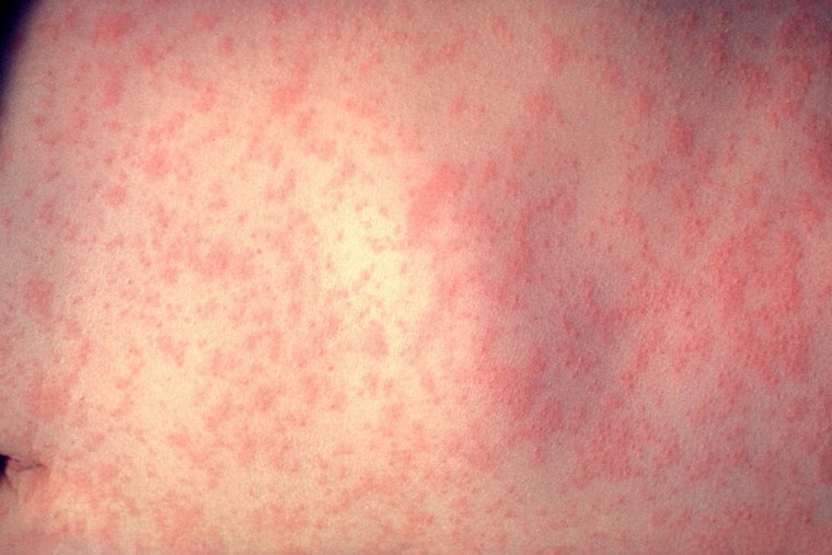 Measles Outbreak in Cuyahoga County Linked to Unvaccinated Children,