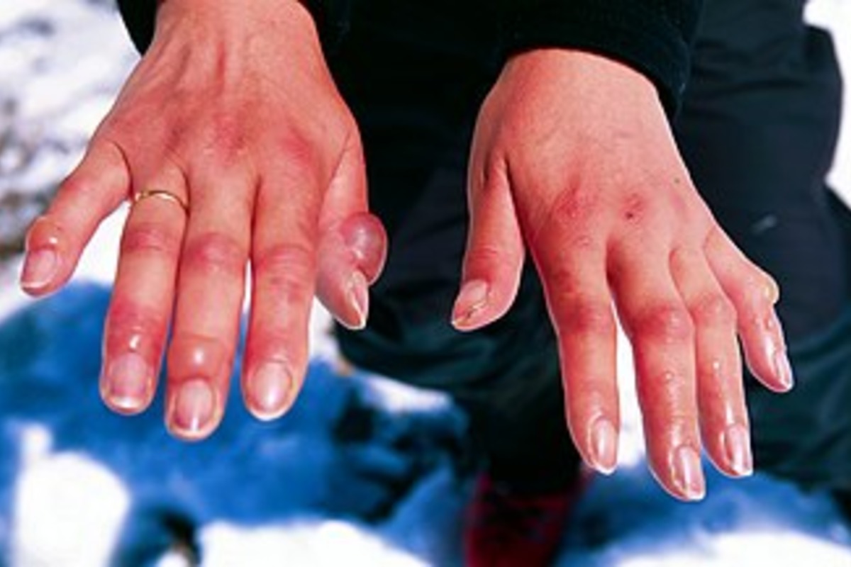 St. Louis Health Department Warns of Frostbite Risks, Urges