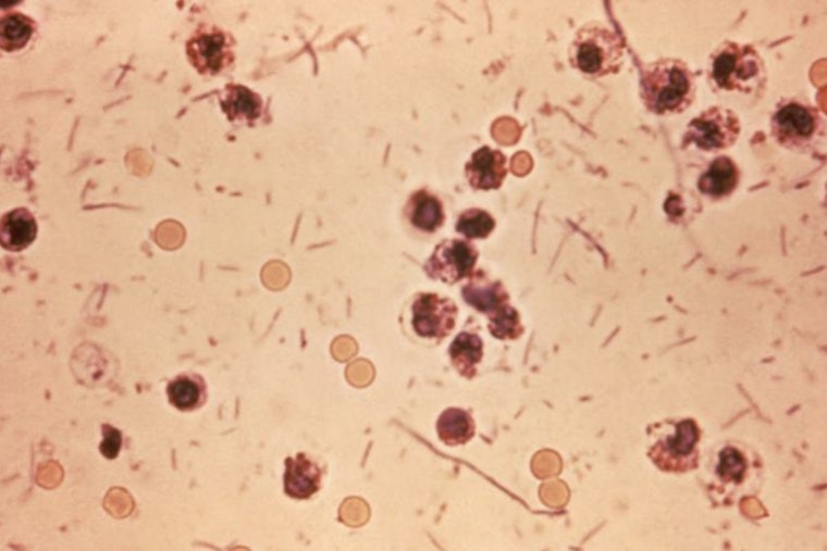 Extensively Drug‑Resistant Shigella Spreading In New York
